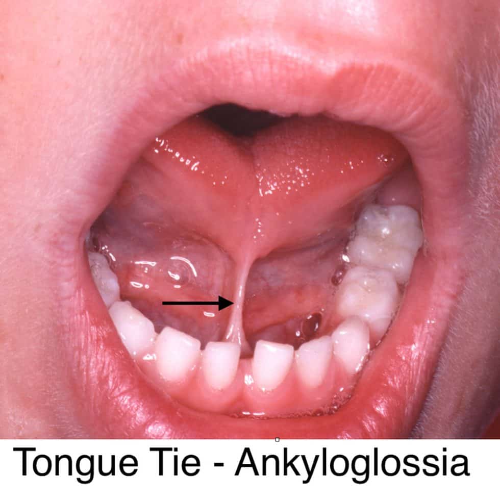 What Is Tongue Tie? Causes, Symptoms & Treatment