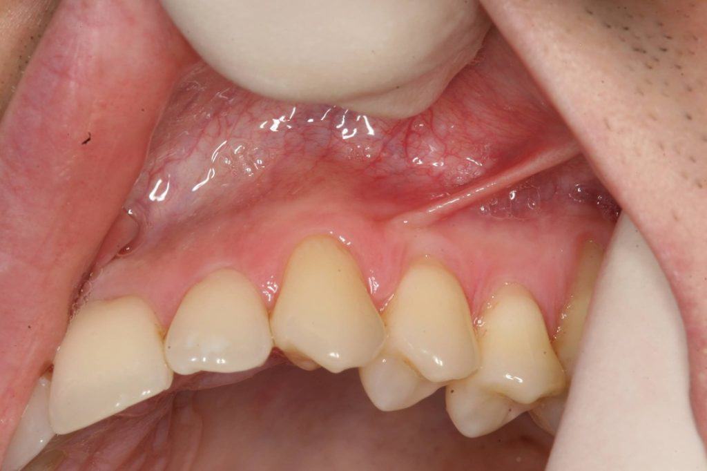 When to get Tongue Tie Release Procedure