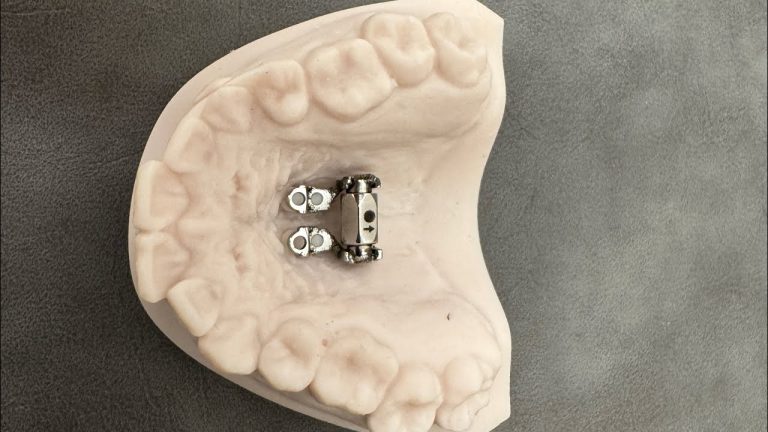 MARPE Adult Palatal Expander Treatment and Cost